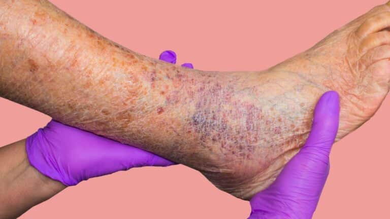 Flebites - Sou Enfermagem