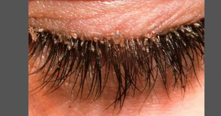 O que é Demodex folliculorum e o que você deve saber - Sou Enfermagem