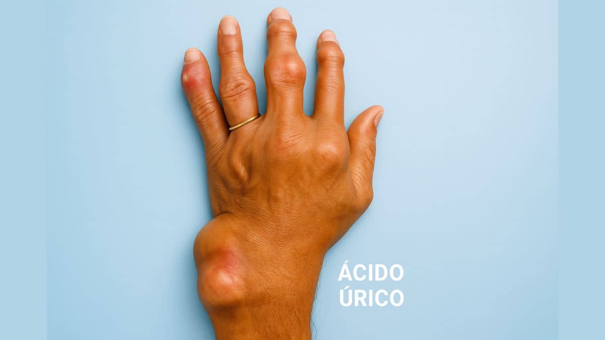 Gota e ácido úrico: sintomas, causas, prevenção e tratamento - Sou ...