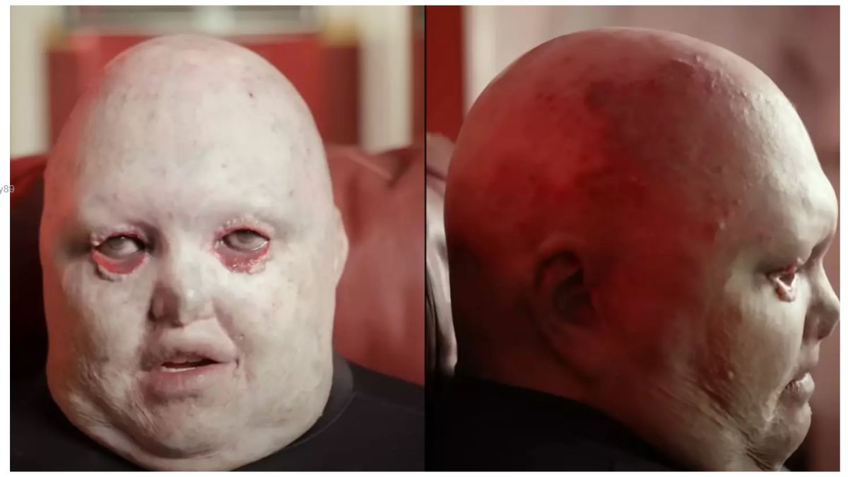 Dean Clifford: a história do homem com epidermólise bolhosa que ...